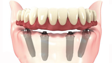 Prótese Protocolo Sobre Implantes - Clinica Inttegra